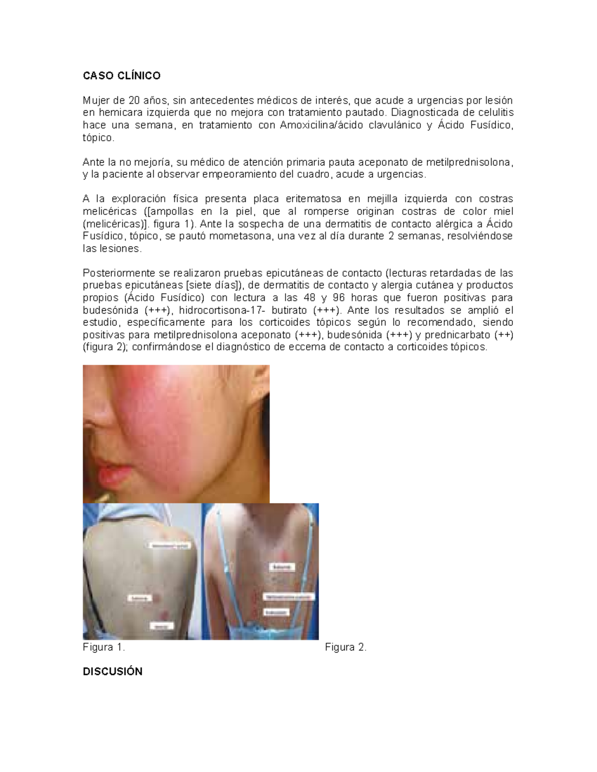 Derma caso - Caso clínico cordicodermias - CASO CLÍNICO Mujer de 20 ...