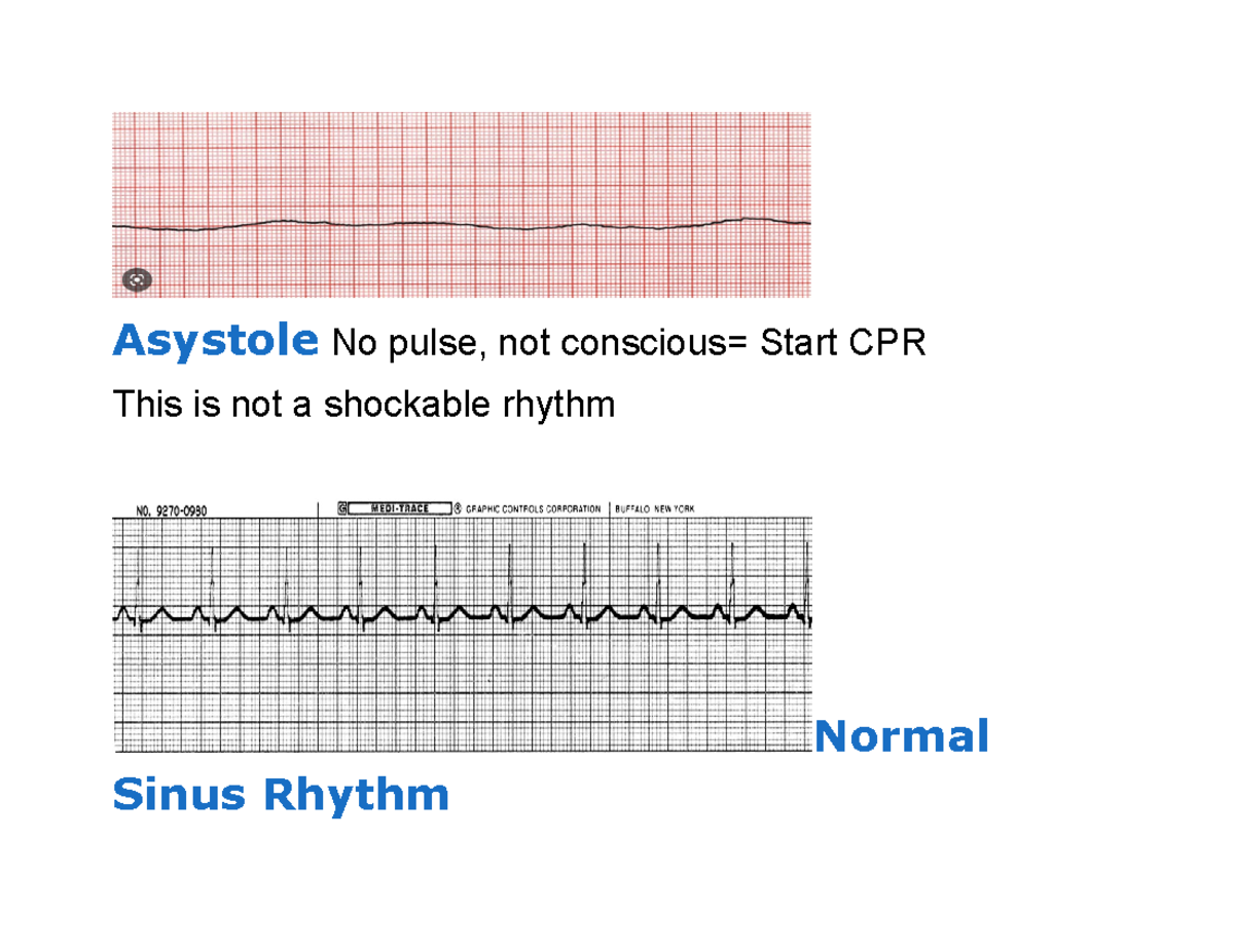 EKG Srips - notes - Asystole No pulse, not conscious= Start CPR This is ...