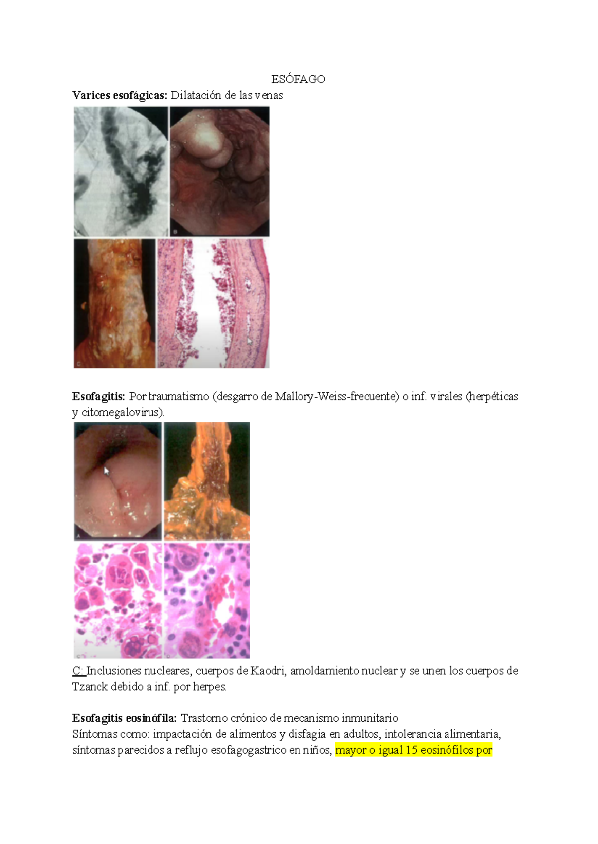 ESÓFAGO - Más apuntes - ESÓFAGO Varices esofágicas: Dilatación de las ...
