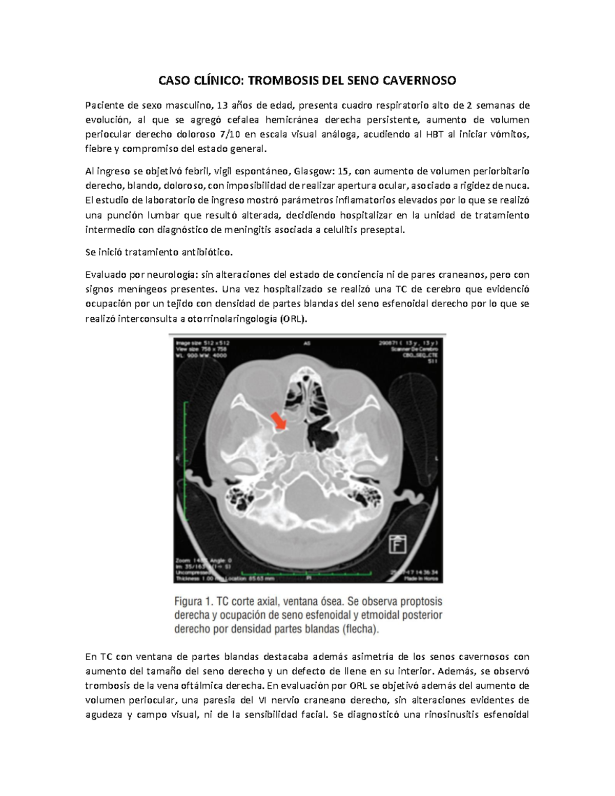 CASO Clínico 2 - Trombosis DEL SENO Cavernoso - CASO CLÕNICO: TROMBOSIS ...