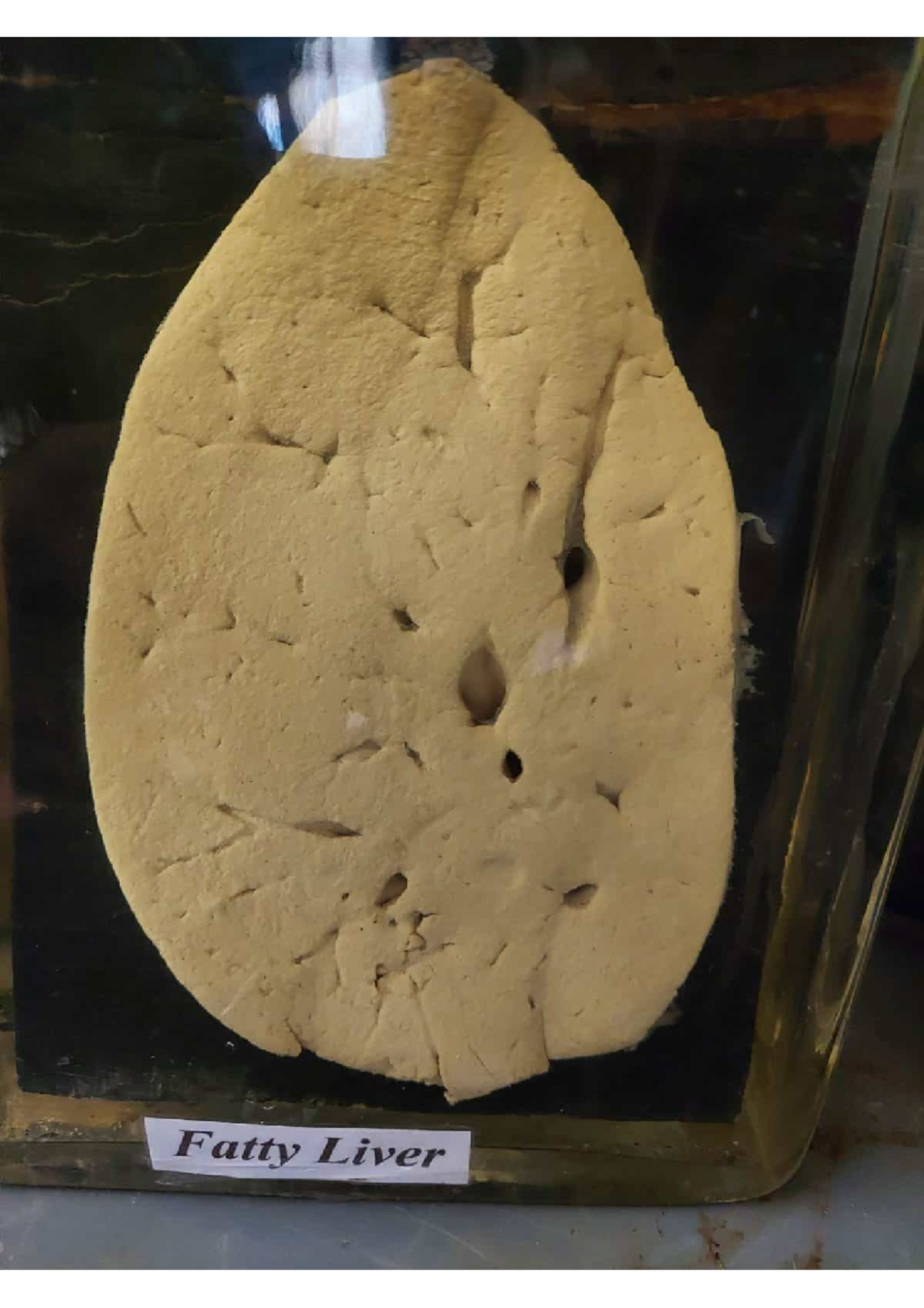 Patho gross specimens - Medicine course - Fatty Liver Fatty Liver ...