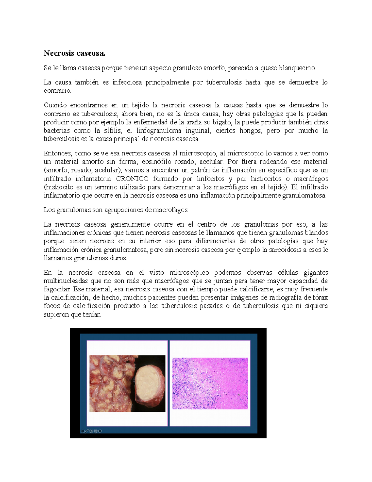 Necrosis caseosa laboratorio - Necrosis caseosa. Se le llama caseosa ...