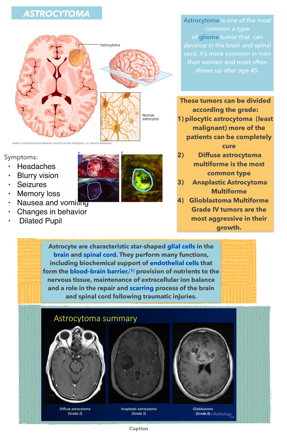 Anatomy astrocytoma - These tumors can be divided according the grade: 1) pilocytic astrocytoma ...
