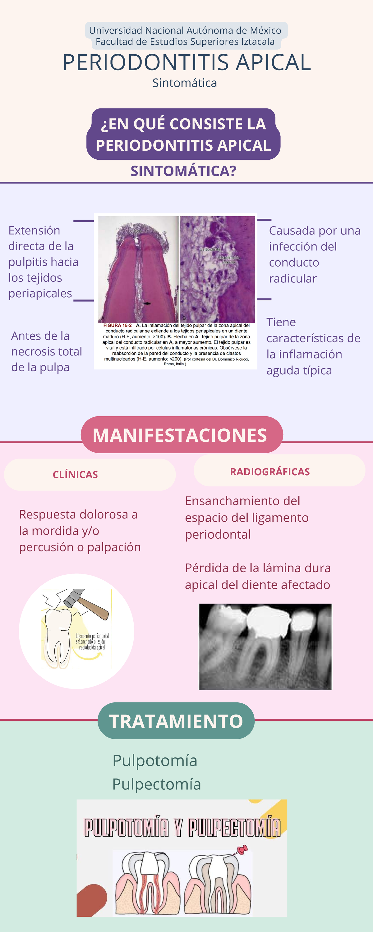 Periodontitis apical aguda - ¿EN QUÉ CONSISTE LA PERIODONTITIS APICAL ...