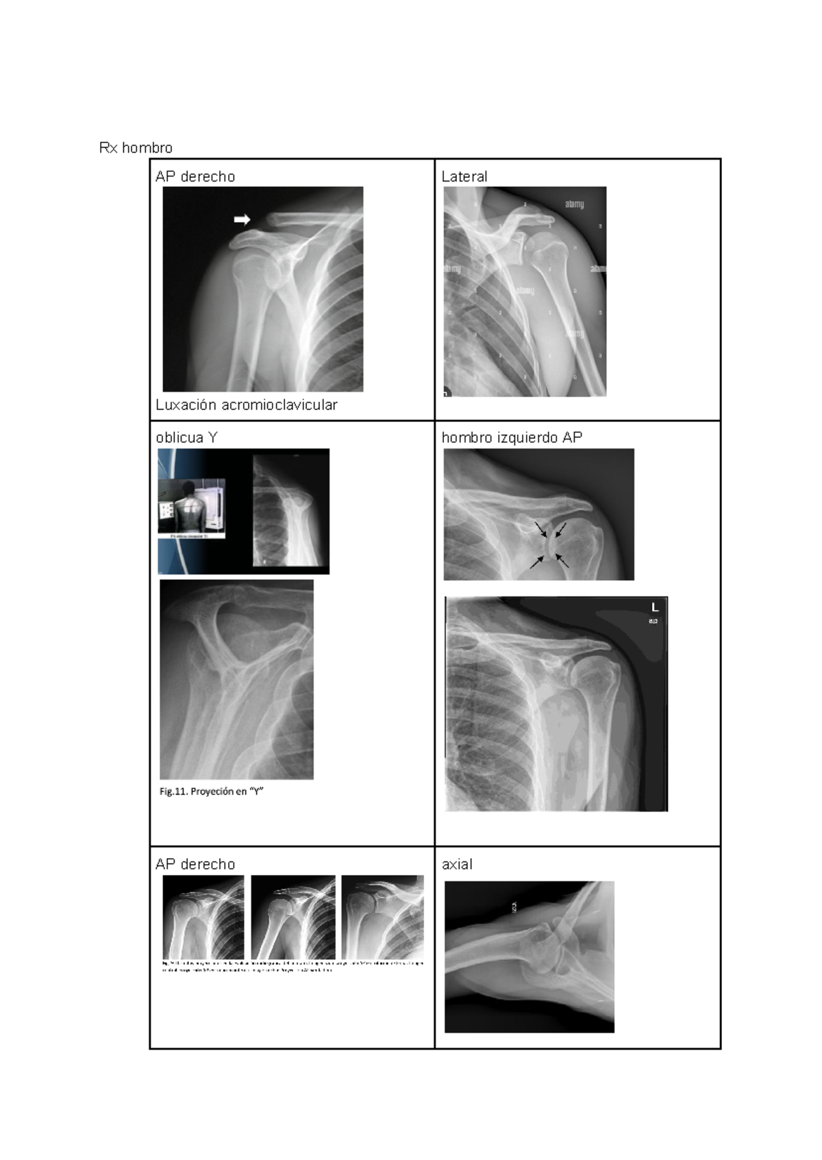 Examen rx - Rx hombro AP derecho Luxación acromioclavicular Lateral oblicua Y hombro izquierdo ...