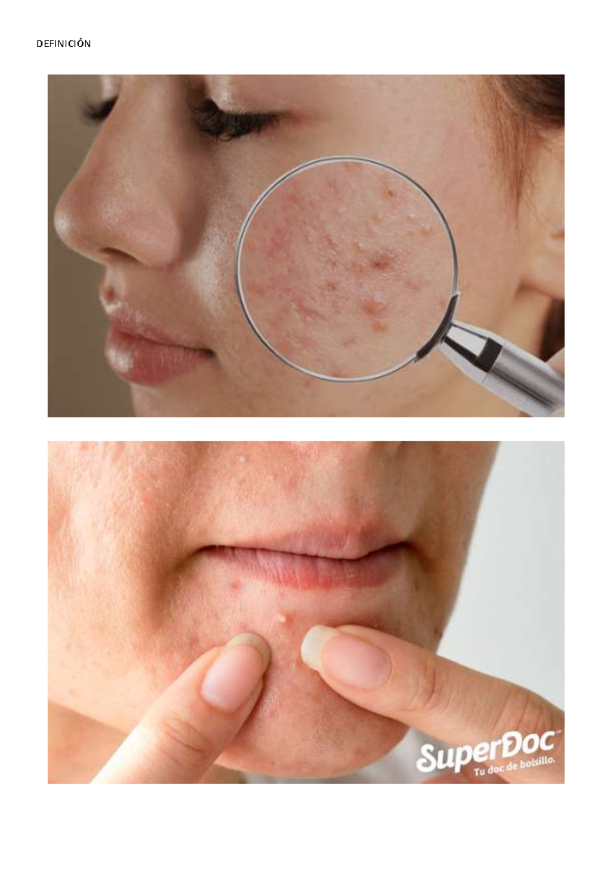 Imágenes del Acné - imagenes del acne - Ciecncias Políticas ...