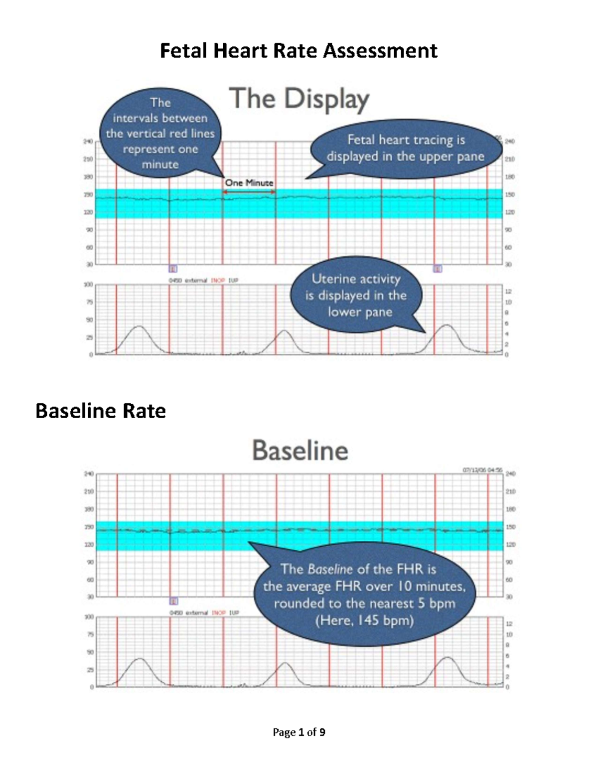 Fetal Monitoring Assessment Strip Interpretation Guide Baseline Rate Baseline Variability
