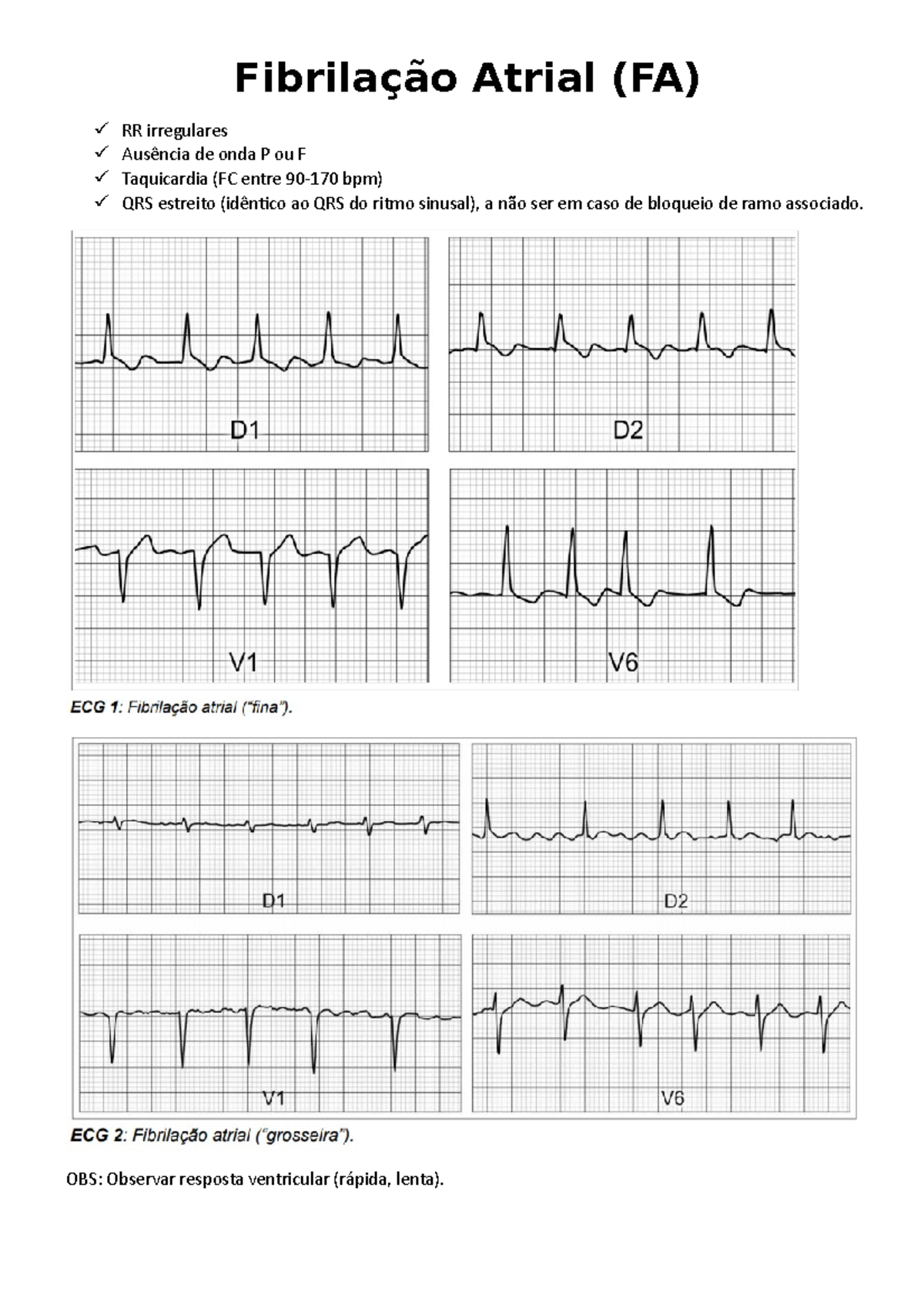 Fibrilação atrial - Fibrilação Atrial (FA) RR irregulares Ausência de ...