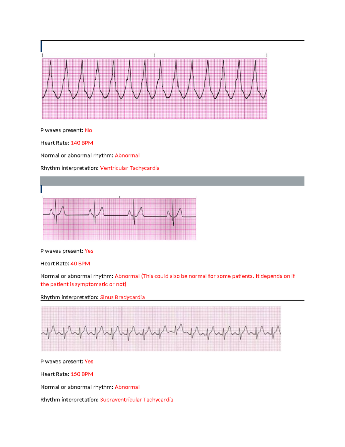 EKG Packet 2021 - P waves present: No Heart Rate: 140 BPM Normal or ...