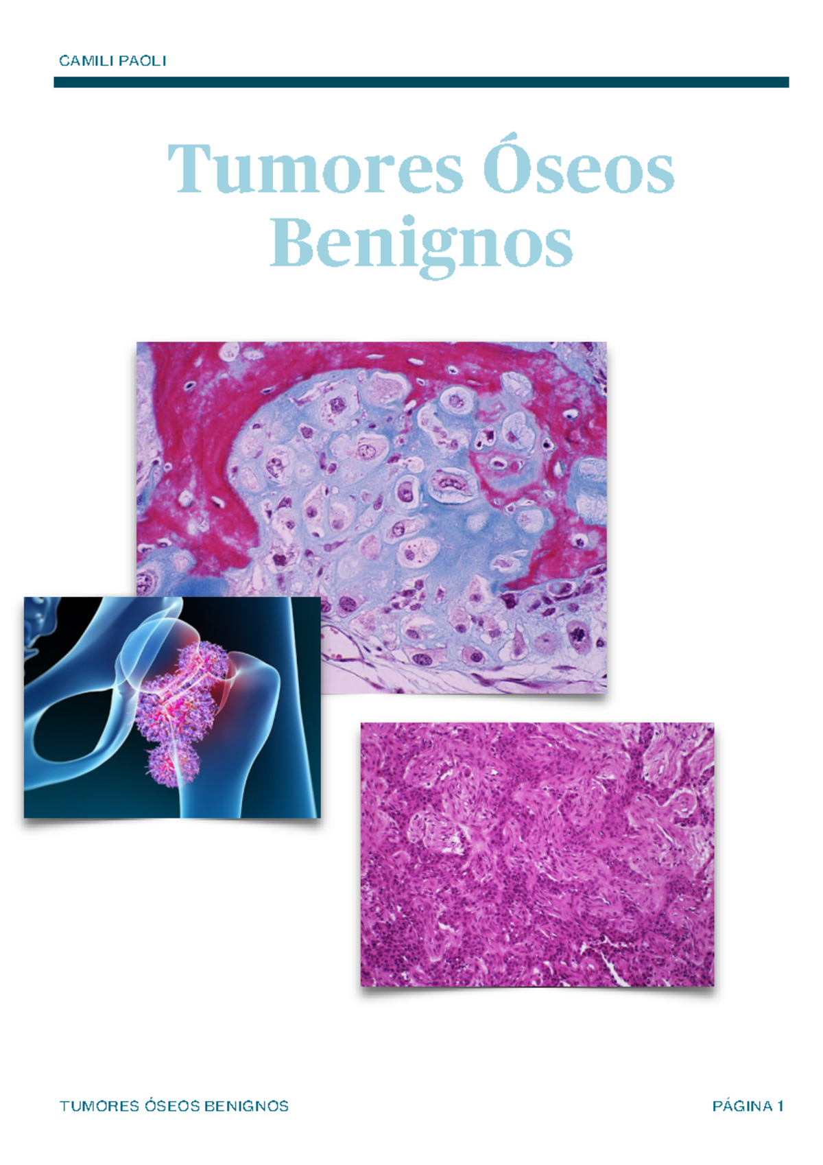 Tumores óseos benignos - Tumores Óseos Benignos Introducción Para empezar, debemos saber que las ...