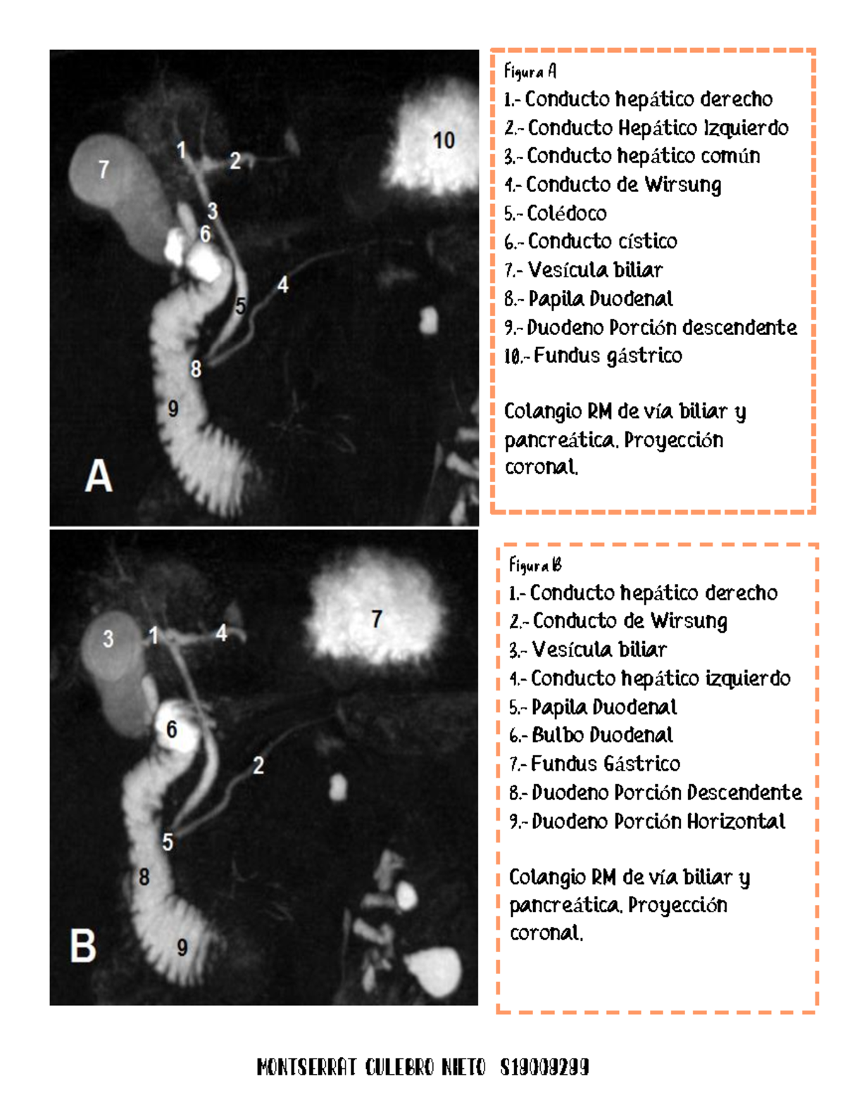 Colangio RM - Anatomia Radiologica y Procedimiento - Warning: TT ...