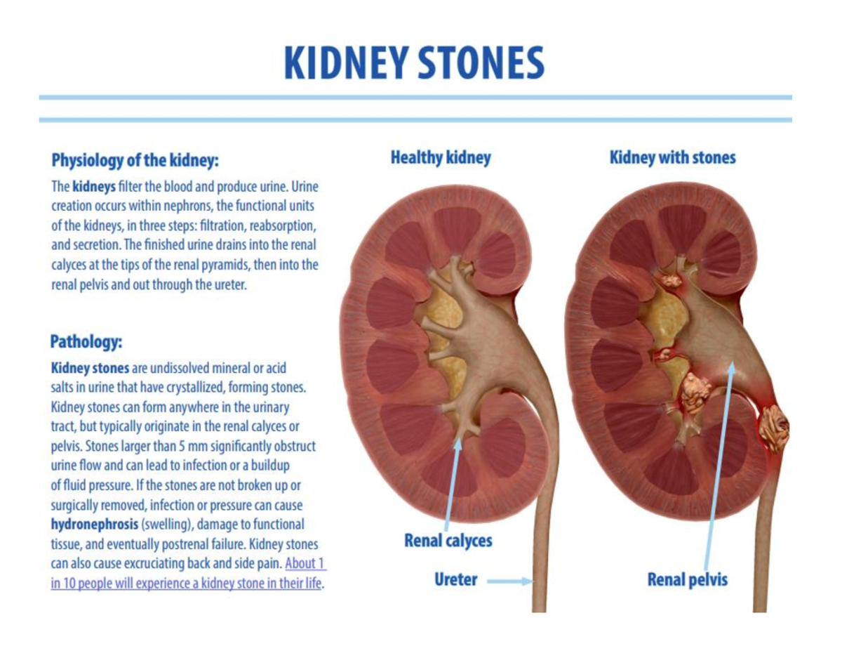 Renal Stones - NUR 251 - Studocu