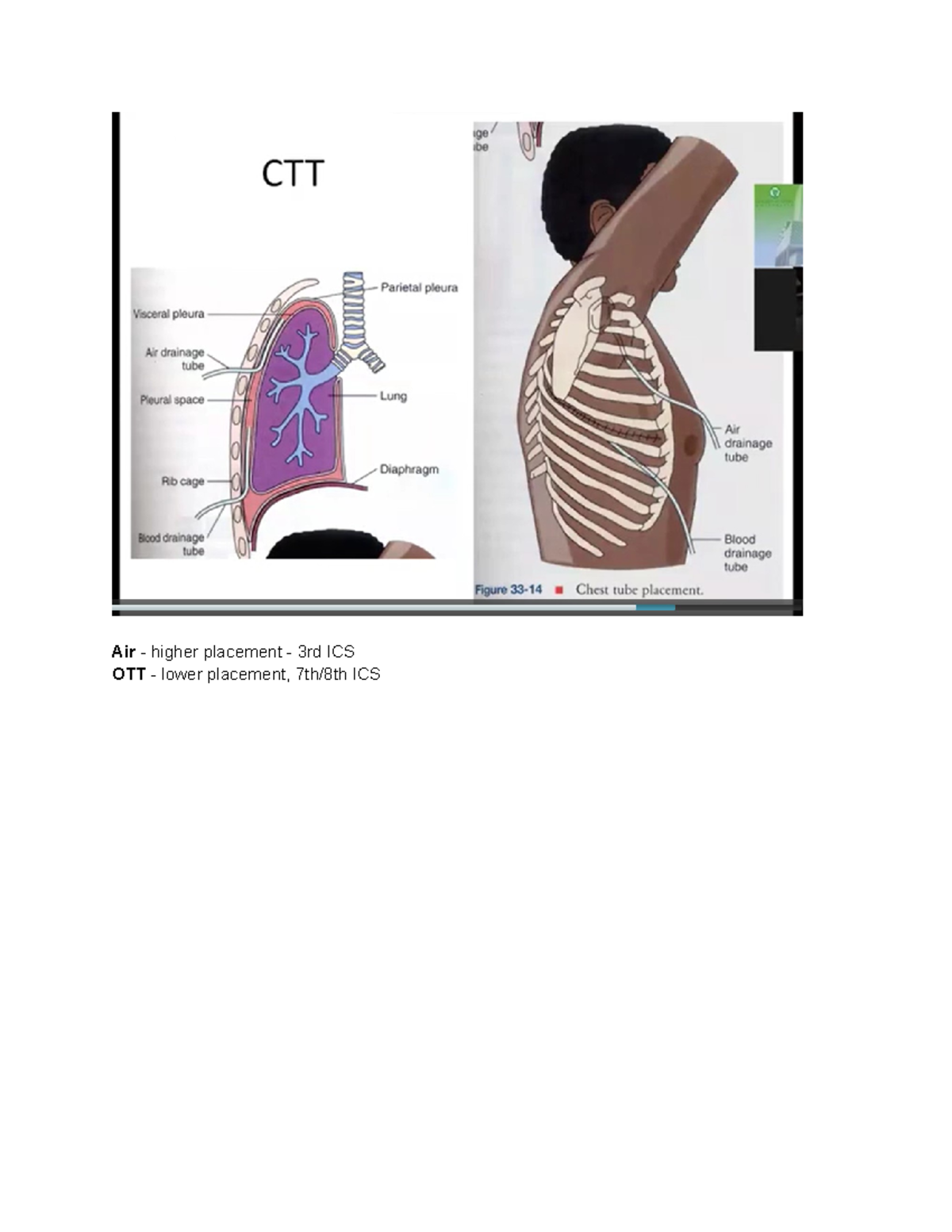 Wk 4 from vid lesson - medsurg - Air - higher placement - 3rd ICS OTT ...
