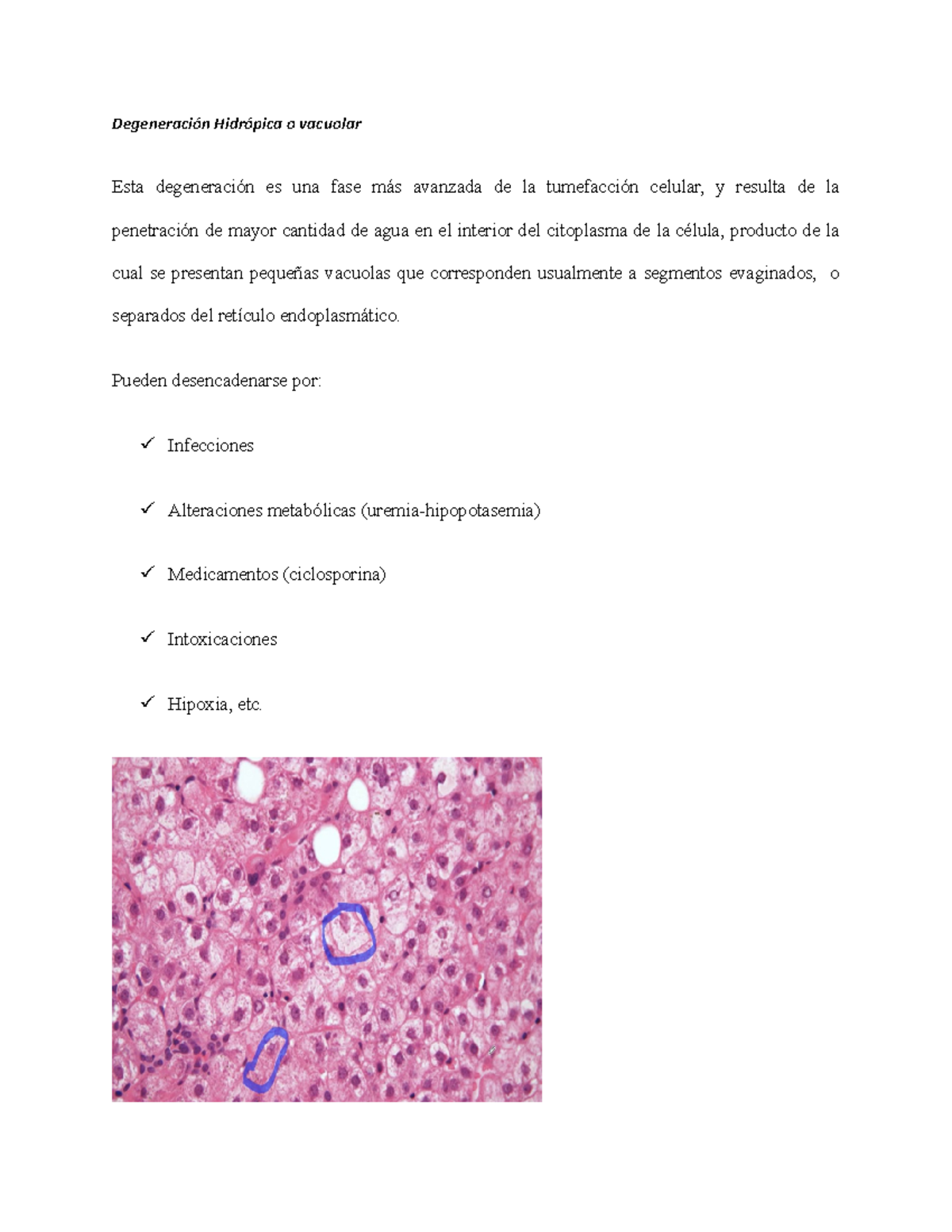 Degeneración Hidrópica o vacuolar Lesion celular irreversible ...