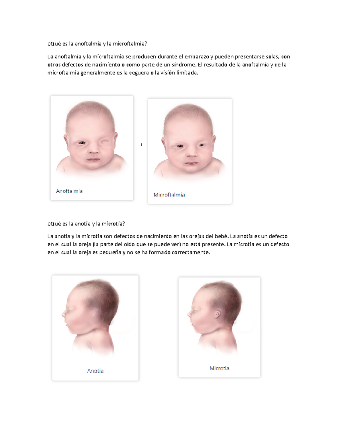 Patologias de bebes - ¿Qué es la anoftalmía y la microftalmia? La ...