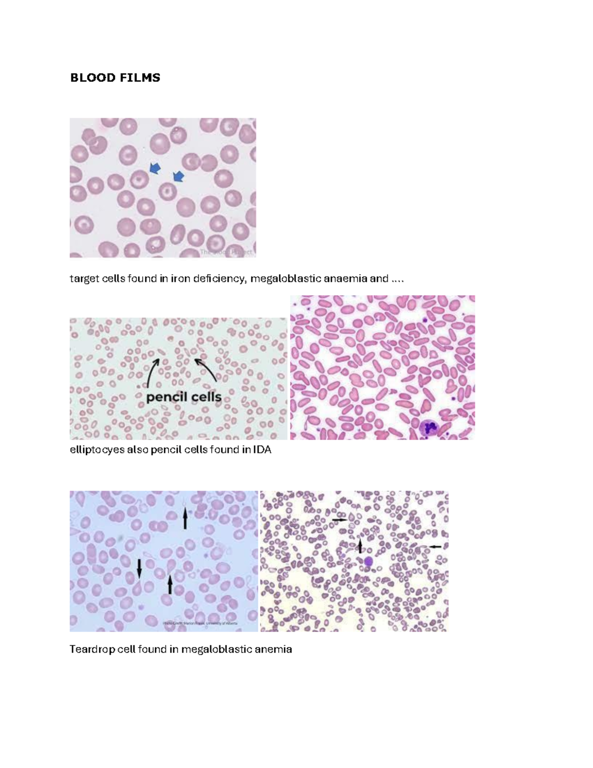 Blood Films for Anaemia cases studies - LS6005 - BLOOD FILMS target ...