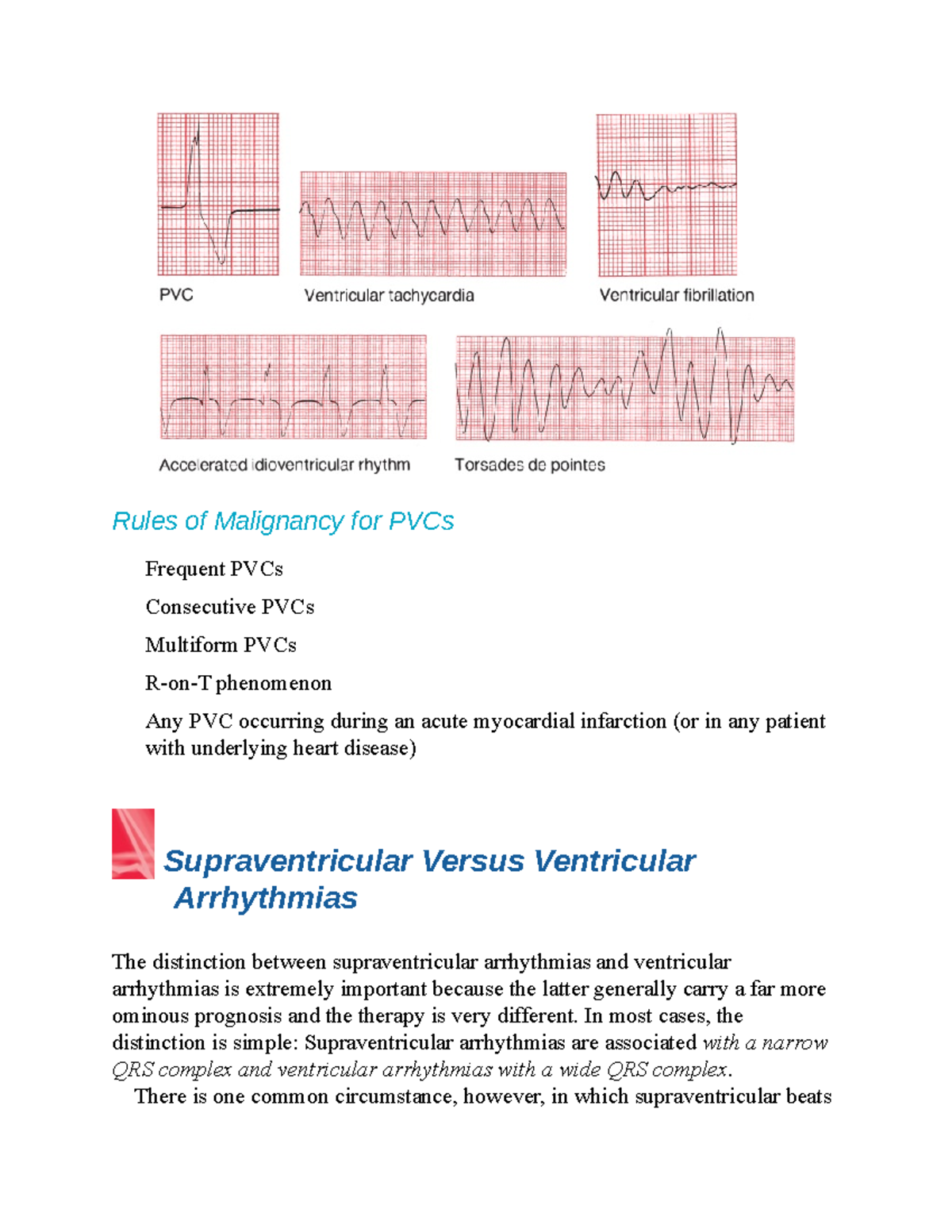 The only EKG-56 - The only EKG - Rules of Malignancy for PVCs Frequent ...
