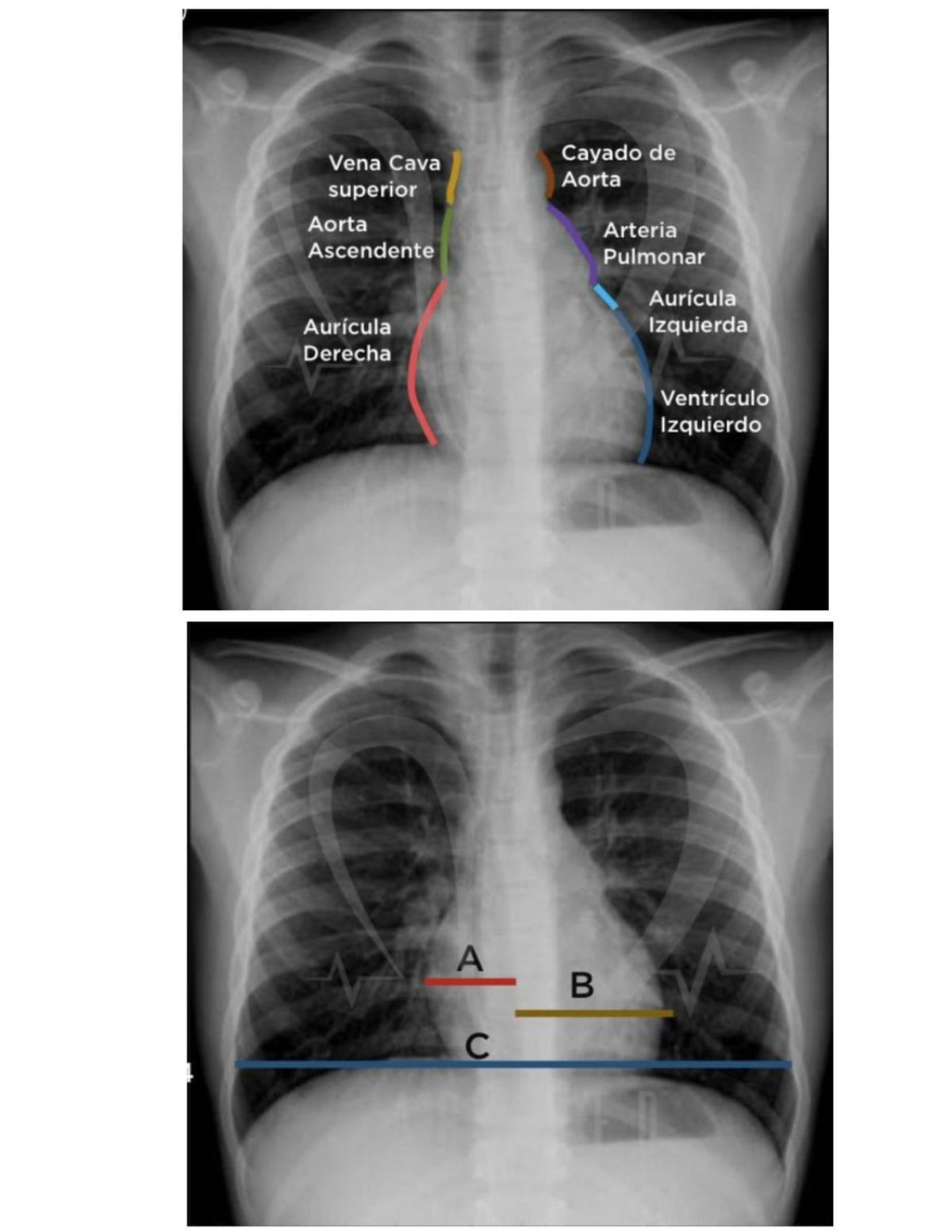 Silueta cardiaca - Imagenología (Radiología) - Vena Cava Cayado de ...