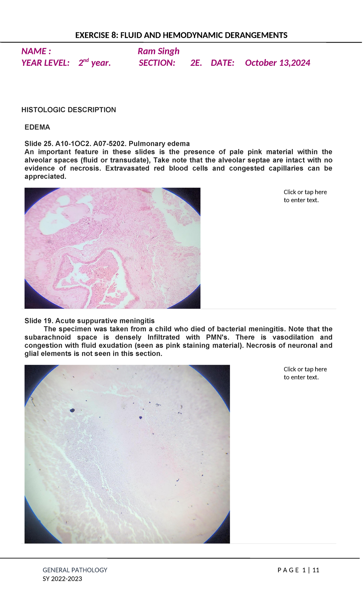 Exercise 8 Fluid AND Hemodynamic Derangements - NAME : Ram Singh YEAR ...