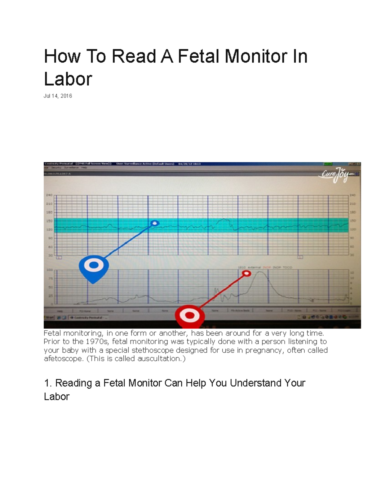 How To Read A Fetal Monitor In Labor - How To Read A Fetal Monitor In ...
