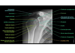 PUÑO Práctica - resumen de puño para RX - Variante en AP: Fractura ...