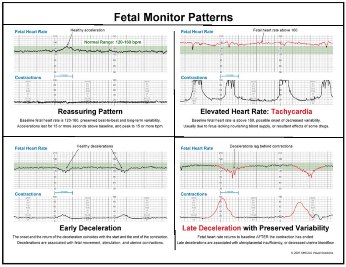 Fetal Heart Rate Patterns Explained - FHR 101 - Fetal Monitor Patterns ...
