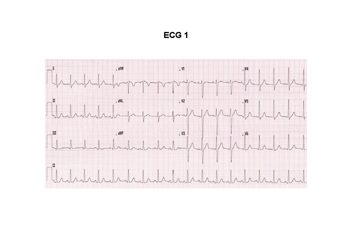 ECG quiz[ 31] - ECG interpretations - ECG 1 = Normal sinus rhythm ECG 2 ...