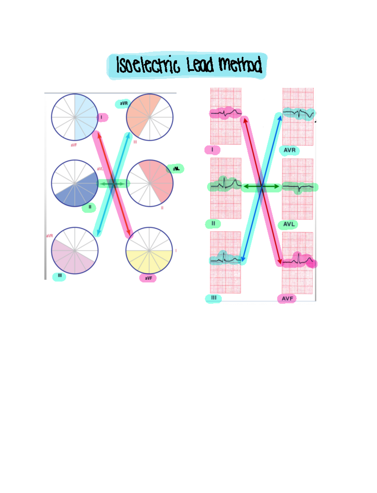 EKG Isoelectric Leads and Blocks - Isoelectric Lead method in auf Lead ...