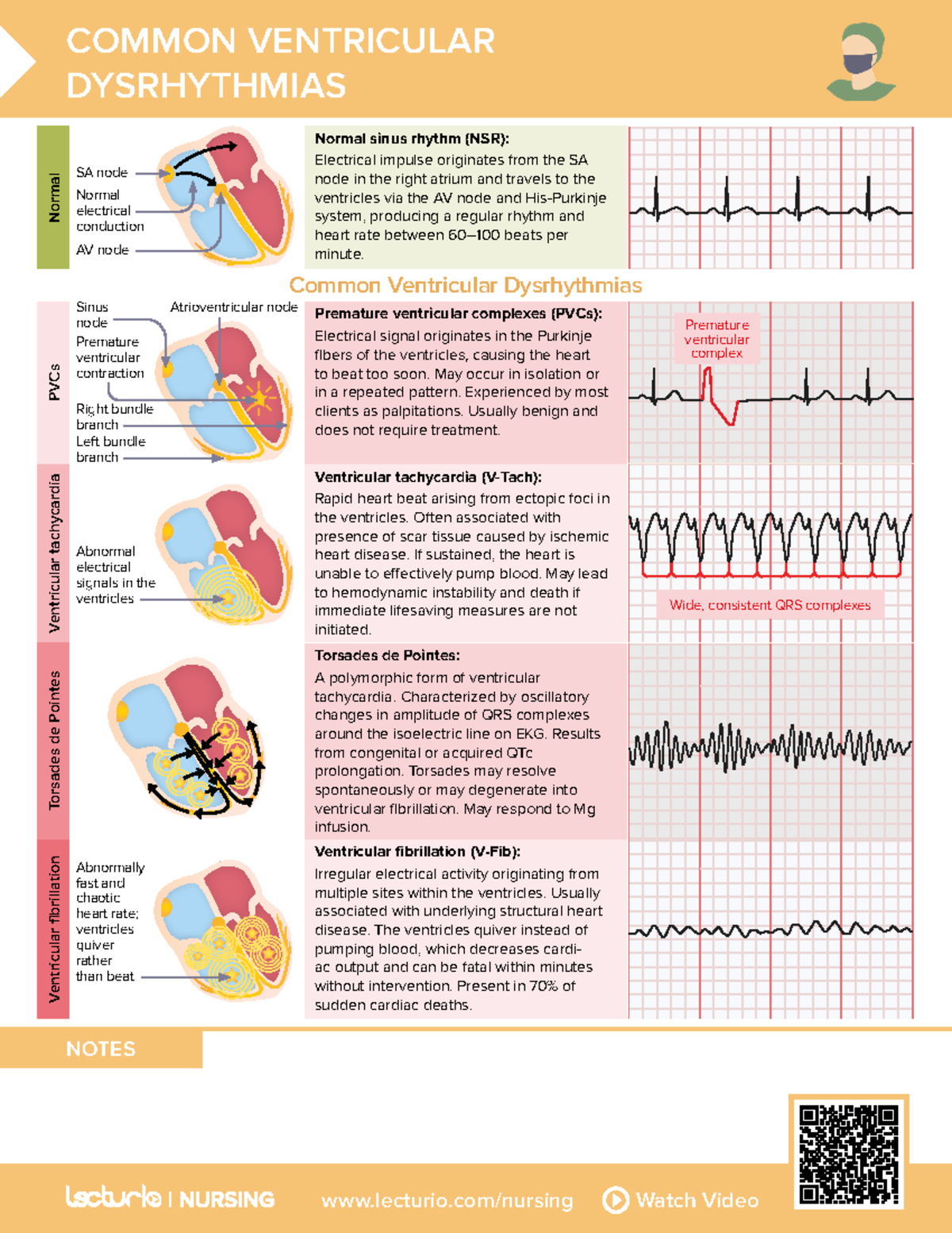 Nursing CS Common-Ventricular-dysrhythmias 03 - lecturio/nursing Watch ...