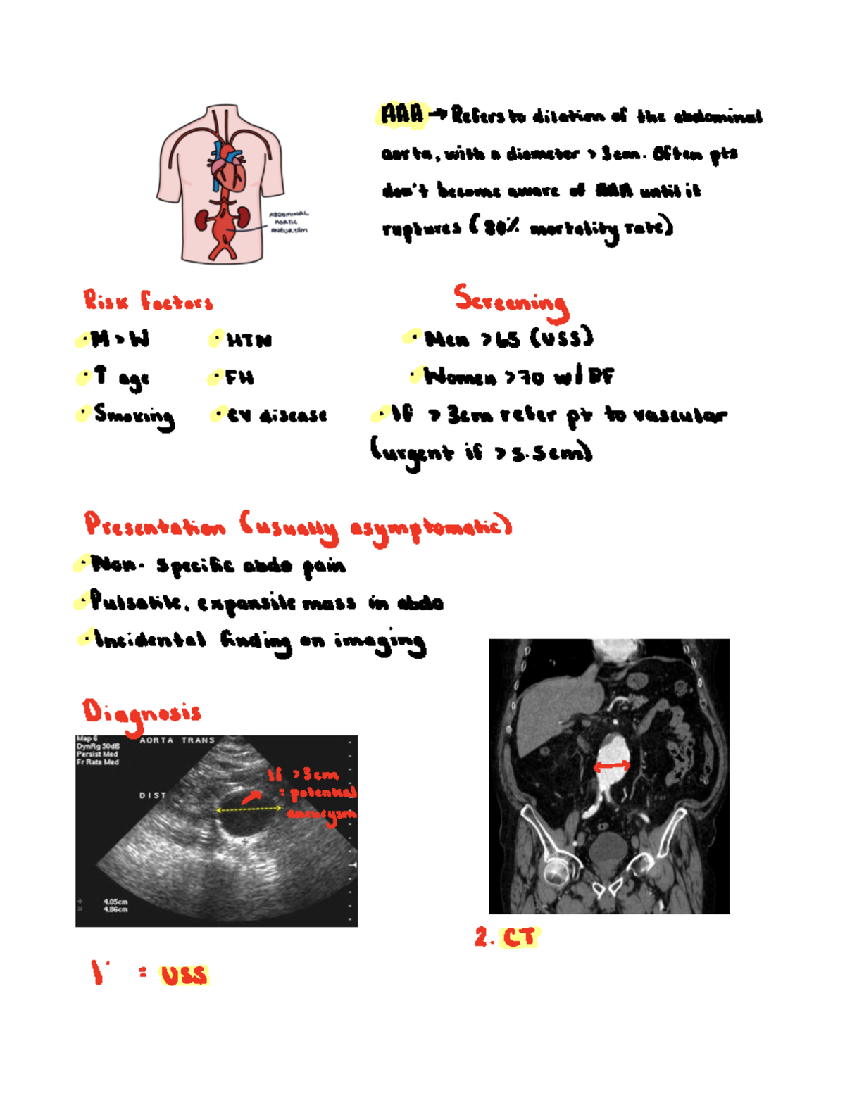 Abdominal aortic aneurysm - ####### AAA Refersto dilation of ...
