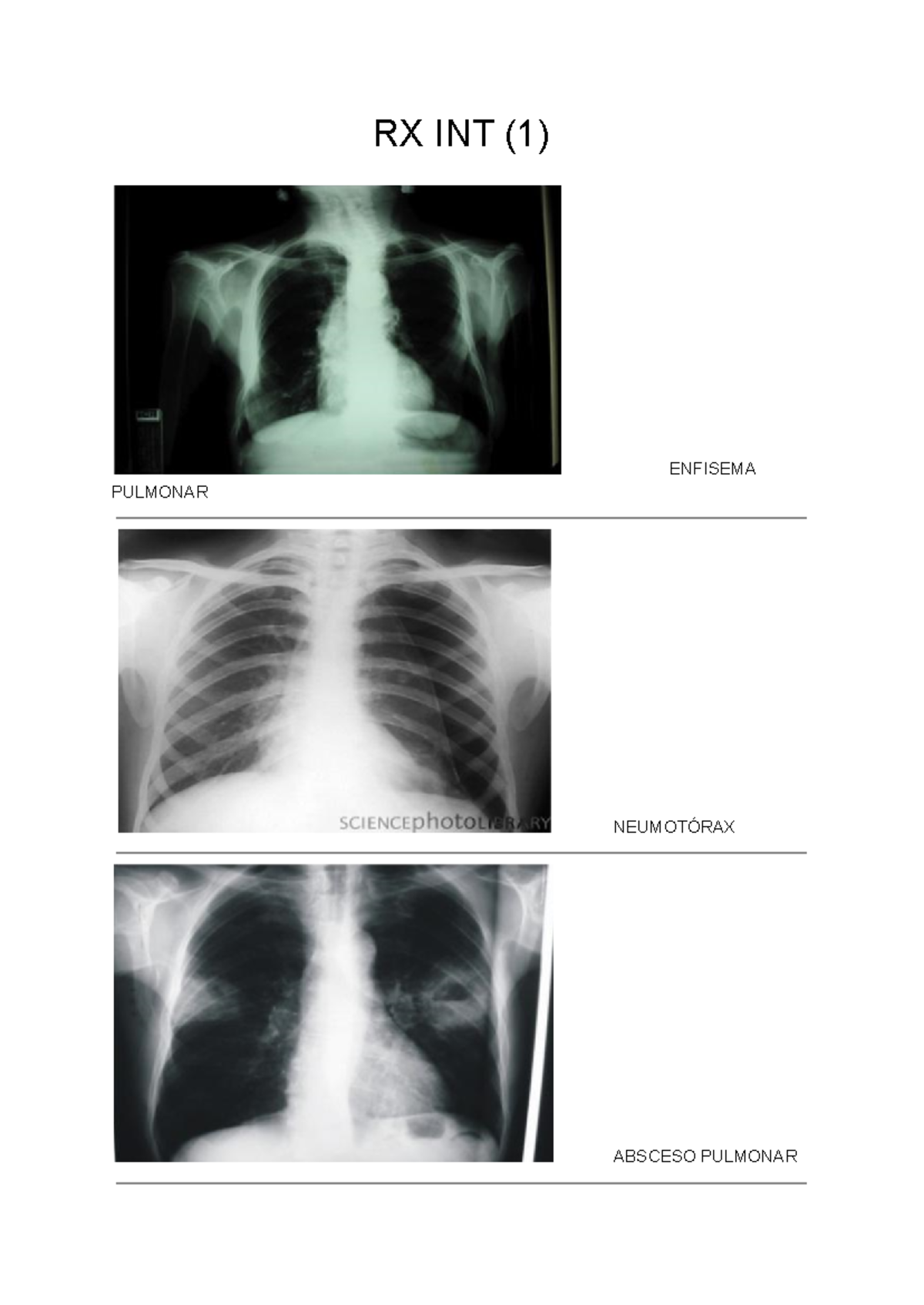 Neumo interpretación de RX - RX INT (1) P ENFISEMA PULMONAR NEUMOTÓRAX ...