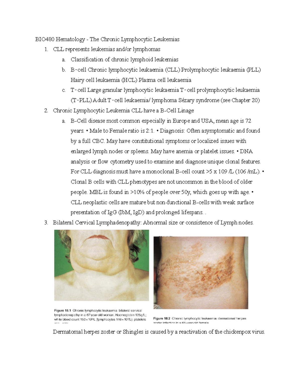 BIO480 Hematology - The Chronic Lymphocytic Leukemias - CLL represents ...