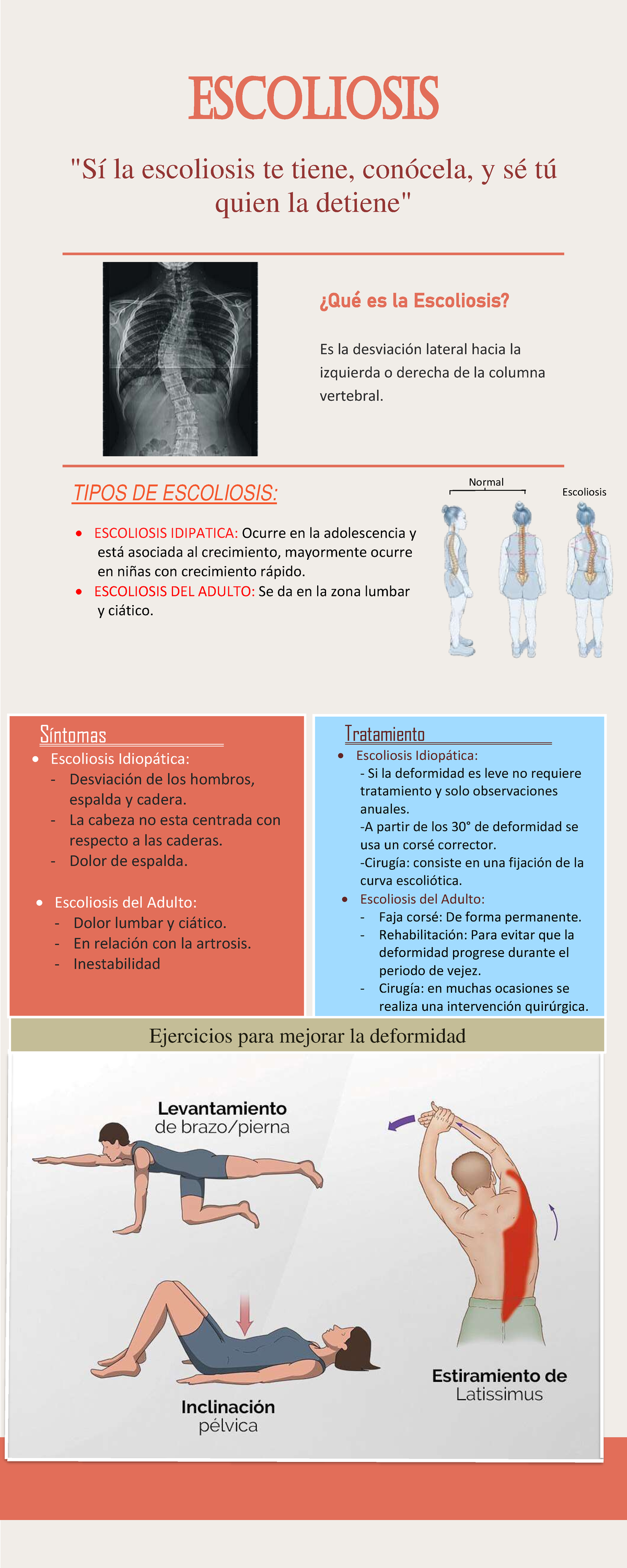 Infografia de escoliosis - escoliosis ¿Qué es la Escoliosis? Es la ...