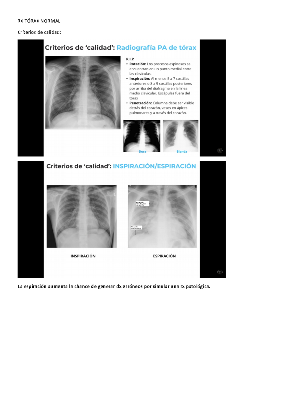 RX Tórax Normal - Resumen de clases de Rx - RX TÓRAX NORMAL Criterios ...