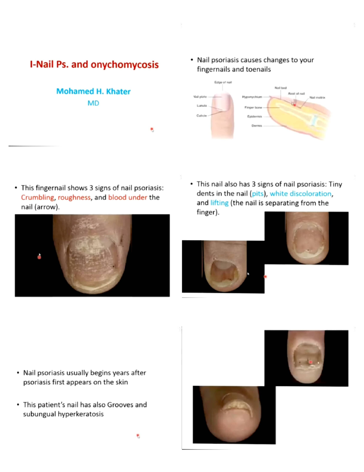 Nail psoriasis vs Onychomycosis - Pharmaceutical Organic Chemistry III ...