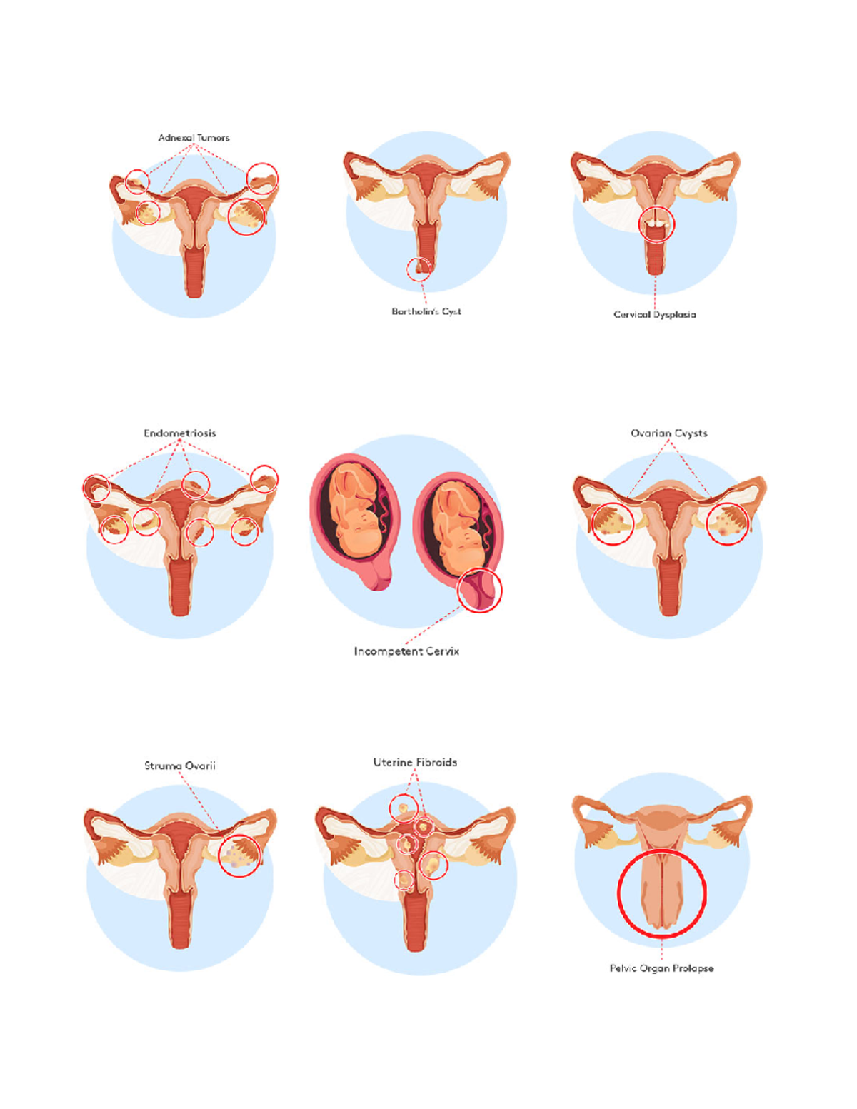 Gynecological Disorders Notes - Almost every woman will suffer from a ...