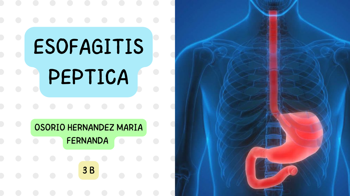 Esofagitis Peptica - ESOFAGITIS PEPTICA OSORIO HERNANDEZ MARIA FERNANDA ...