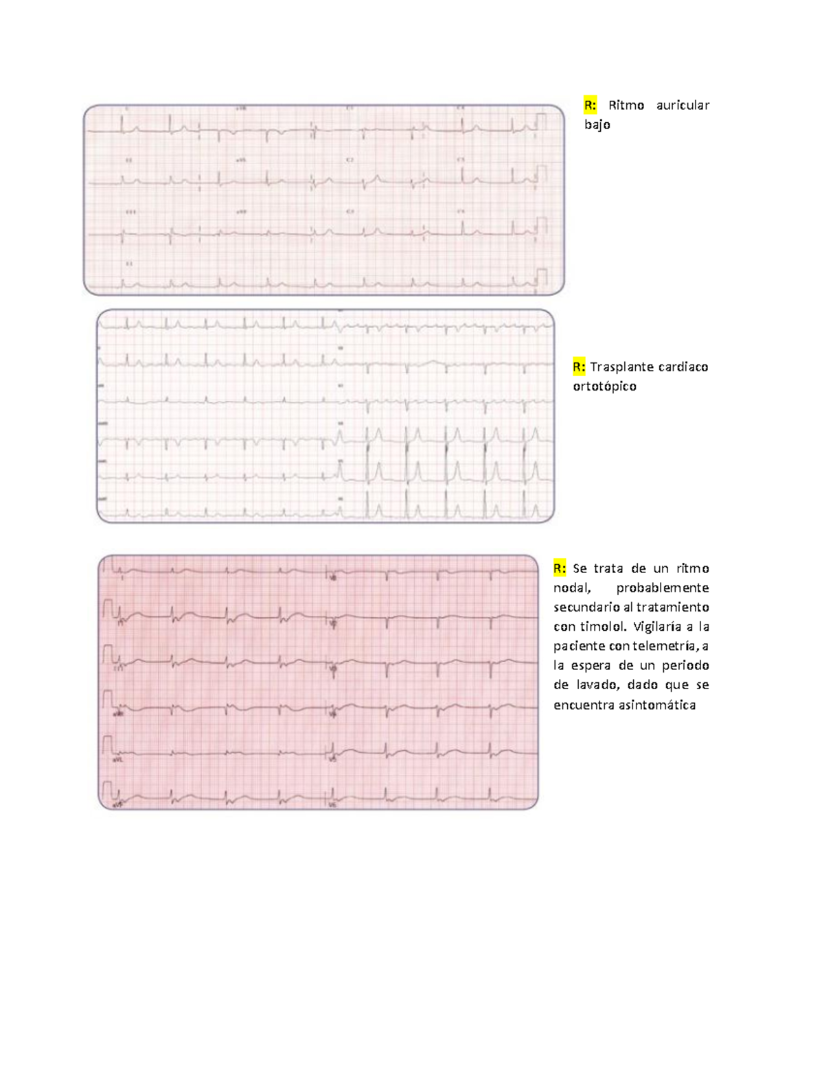 EKG - EKG - R: Ritmo auricular bajo R: Trasplante cardiaco ortotópico R ...