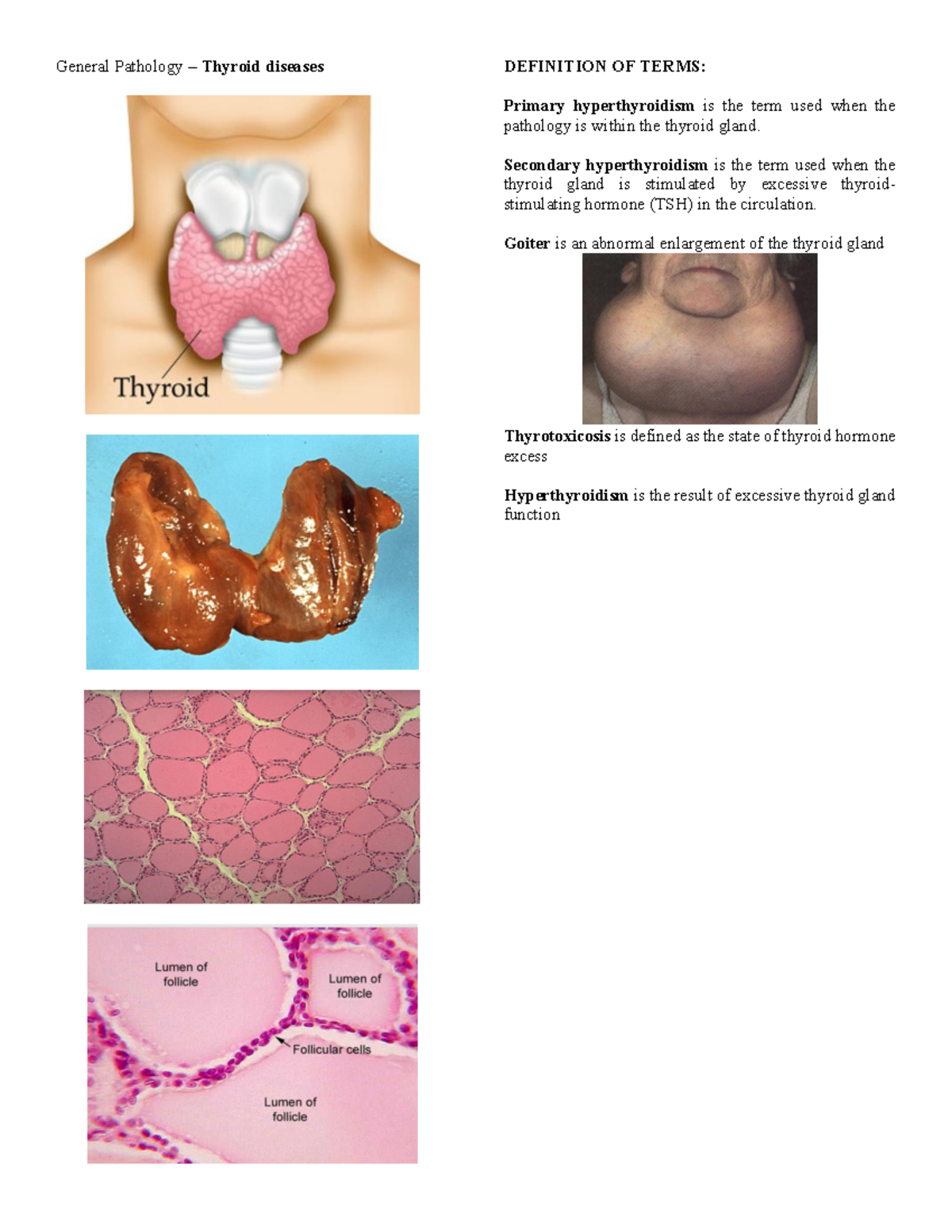 3 - Thyroid Neoplasms - ana - General Pathology Thyroid diseases ...