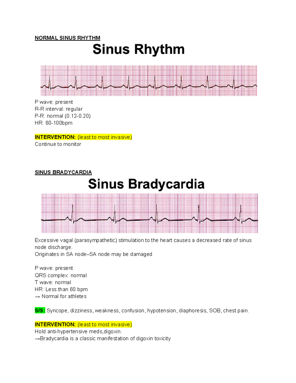 EKGs - EKG information - NORMAL SINUS RHYTHM P wave: present R-R ...