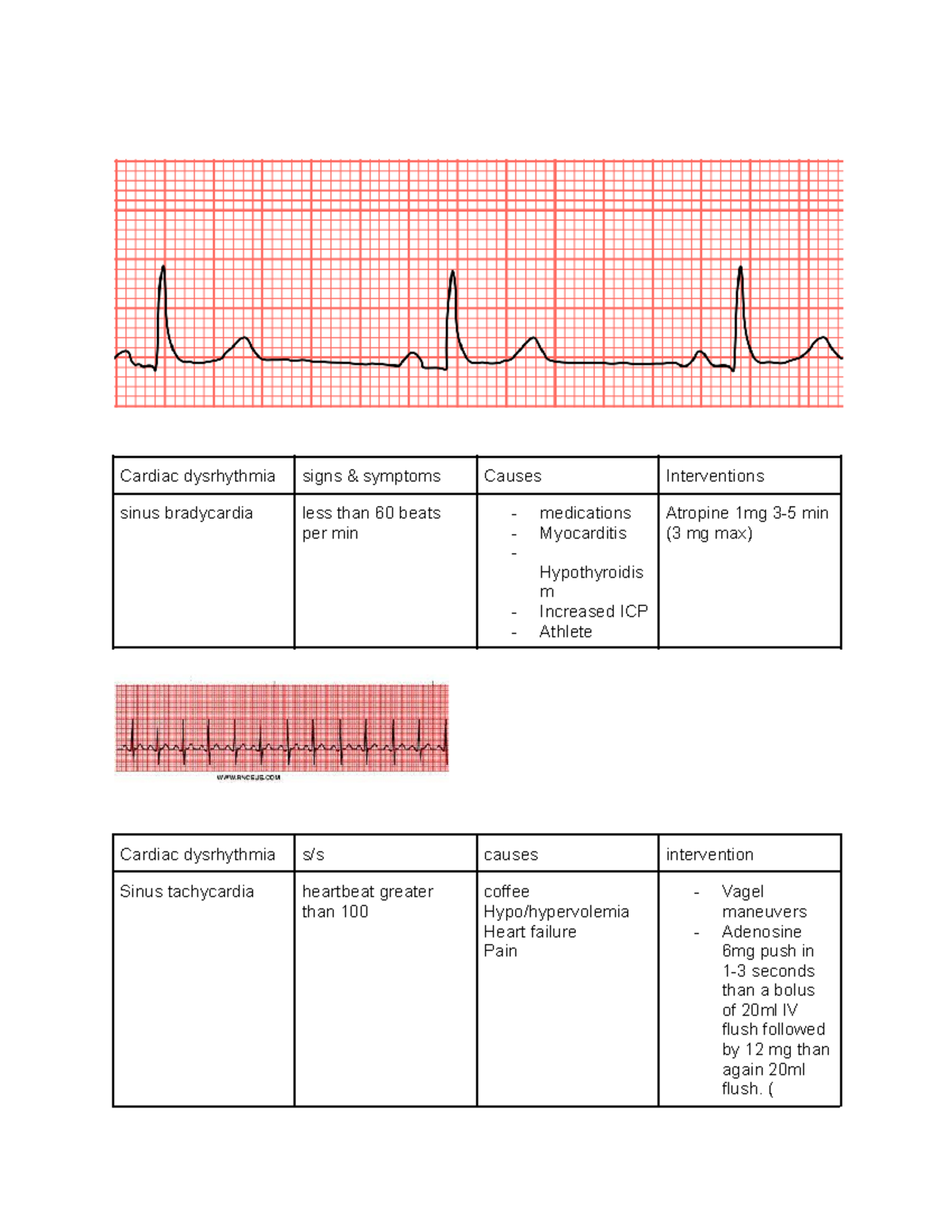 Cardiac strips - Cardiac dysrhythmia signs & symptoms Causes ...