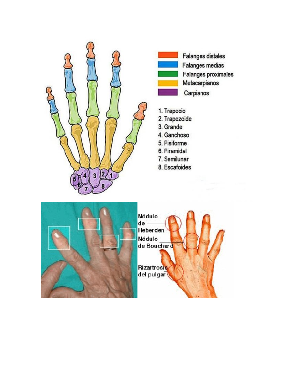 Reumatologia clase - Artrosis de las articulaciones interfalángicas ...