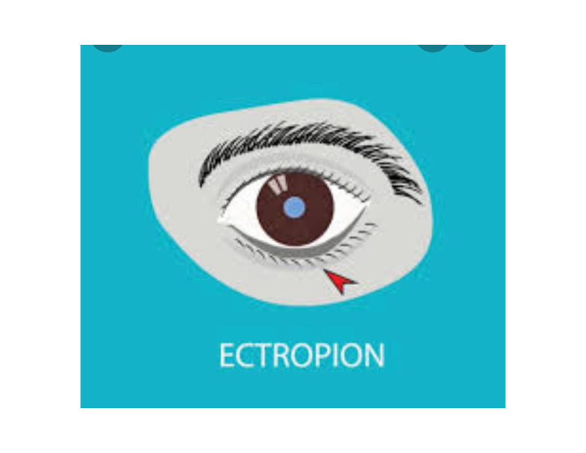 Ectropion eye disease - Bsc.optometry - Studocu