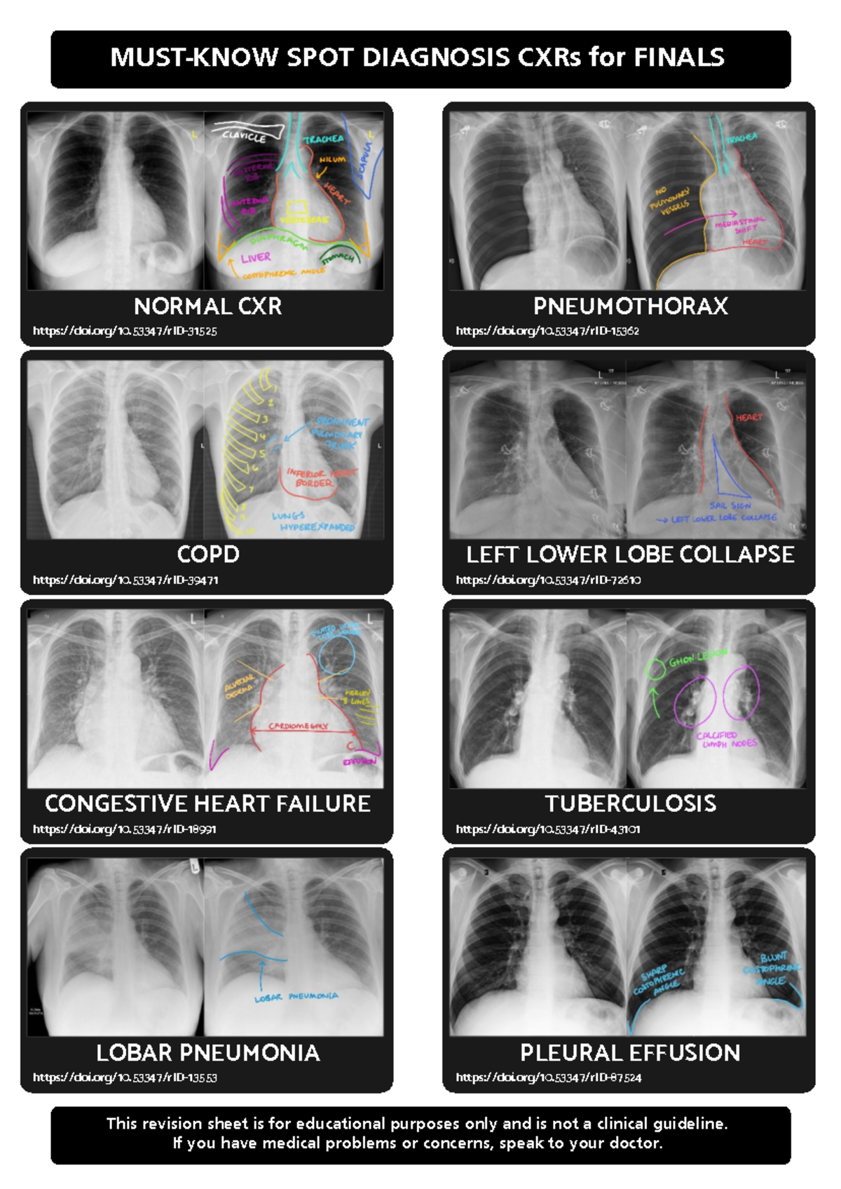 Cxr handout - NORMAL CXR This revision sheet is for educational ...