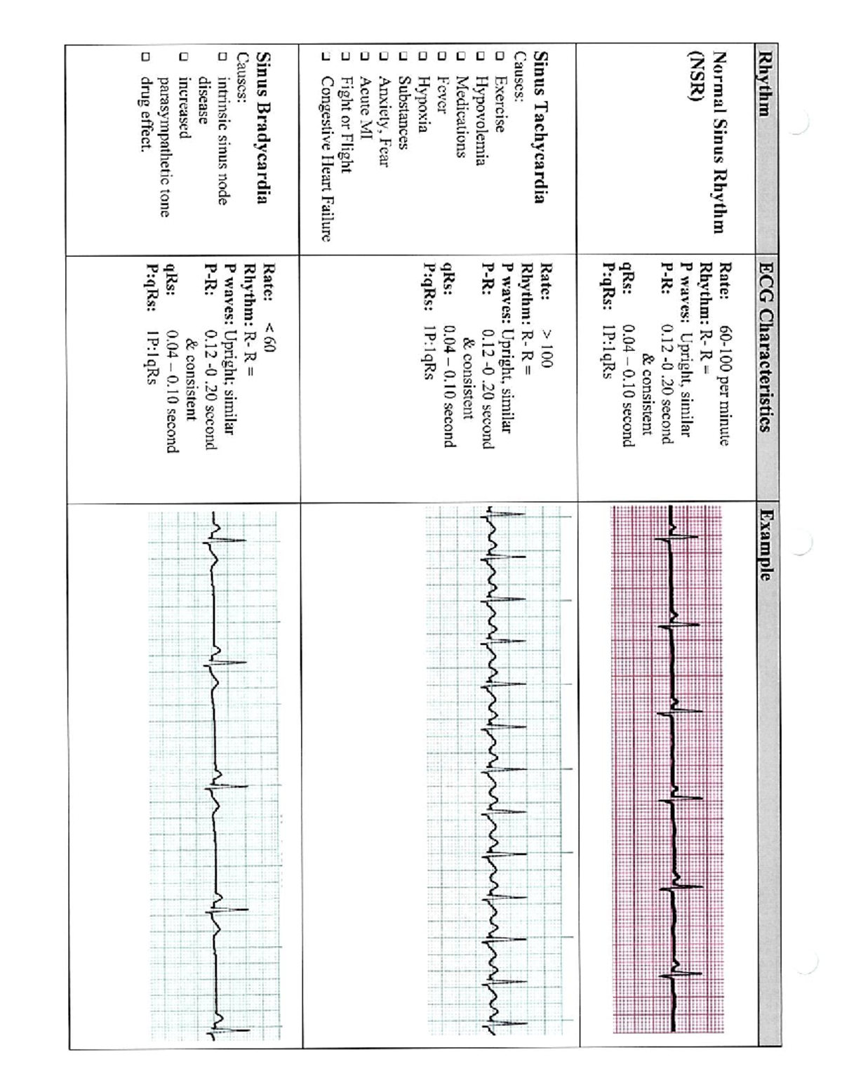 ECG Rhythm Strips - notes - Rhythm ECG Characteristics Example Normal ...