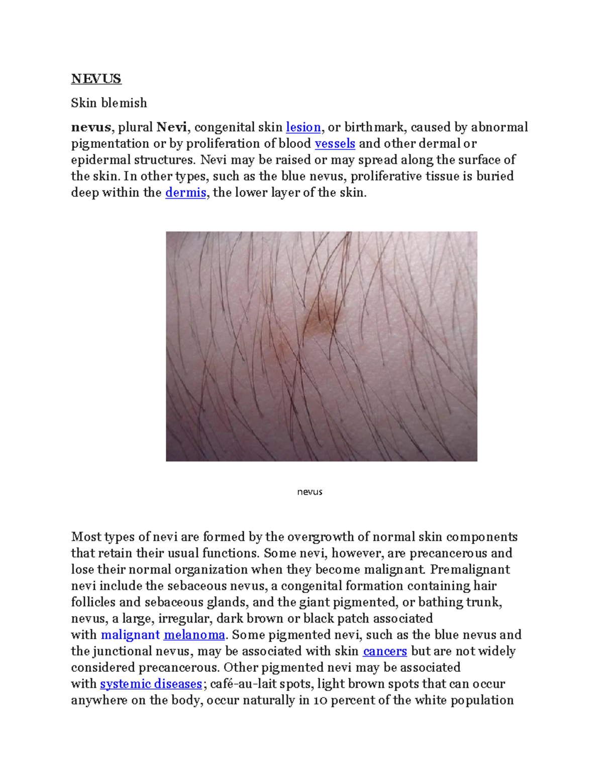 Nevus - #detailed description - NEVUS Skin blemish nevus, plural Nevi, congenital skin lesion ...