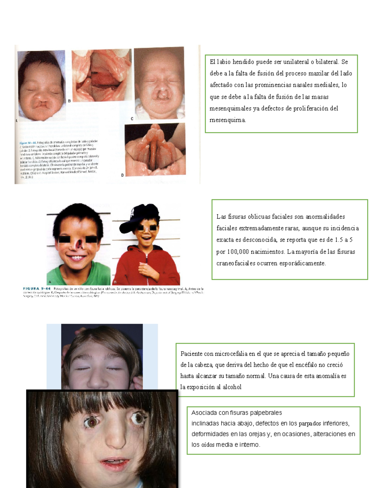 Anomalias DE LA CARA - Paciente con microcefalia en el que se aprecia ...