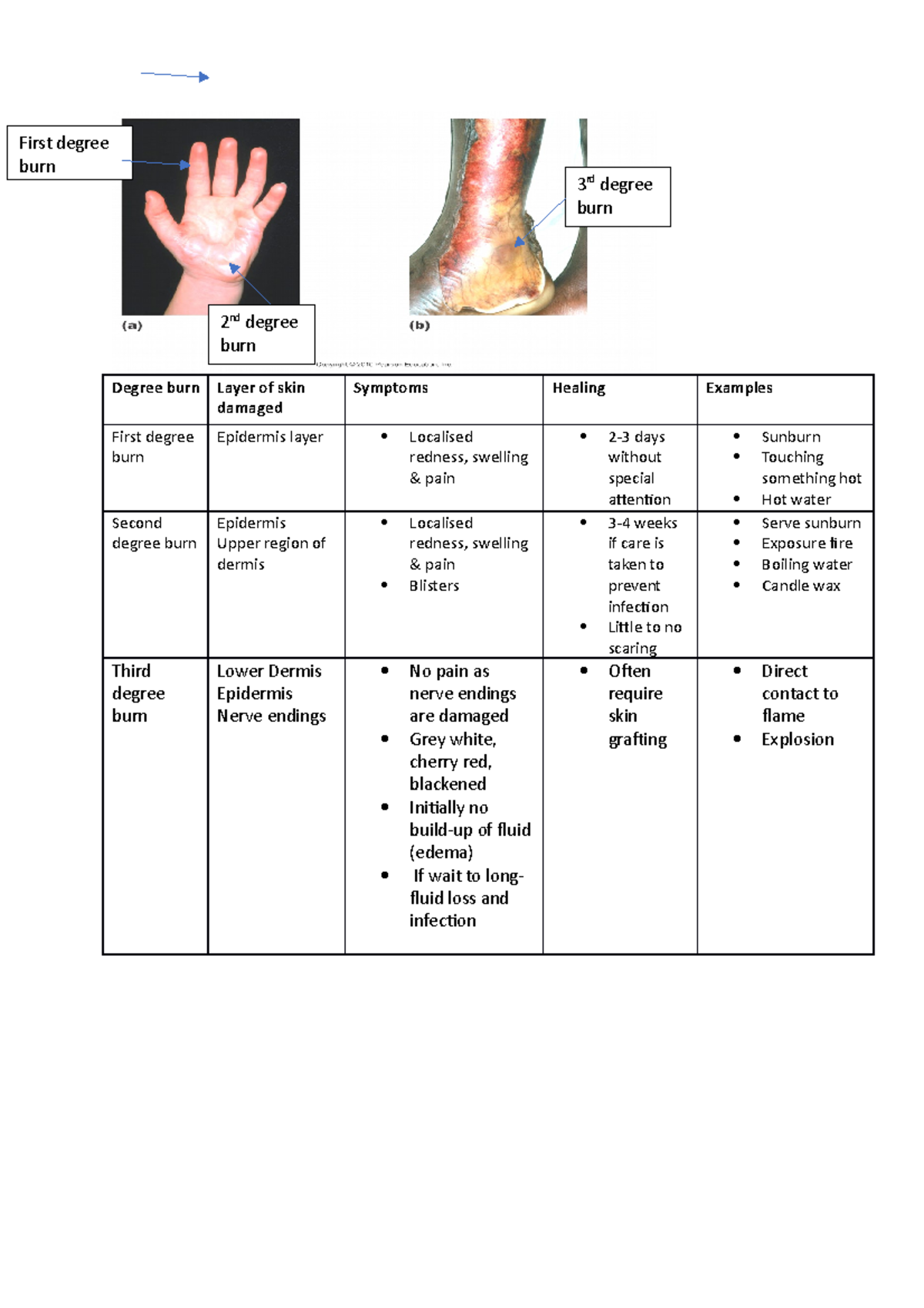 Burns - Degree burn Layer of skin damaged Symptoms Healing Examples ...