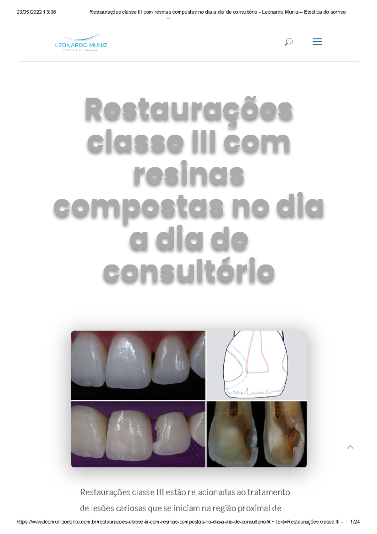 Restaurações classe III com resinas compostas no dia a dia de ...