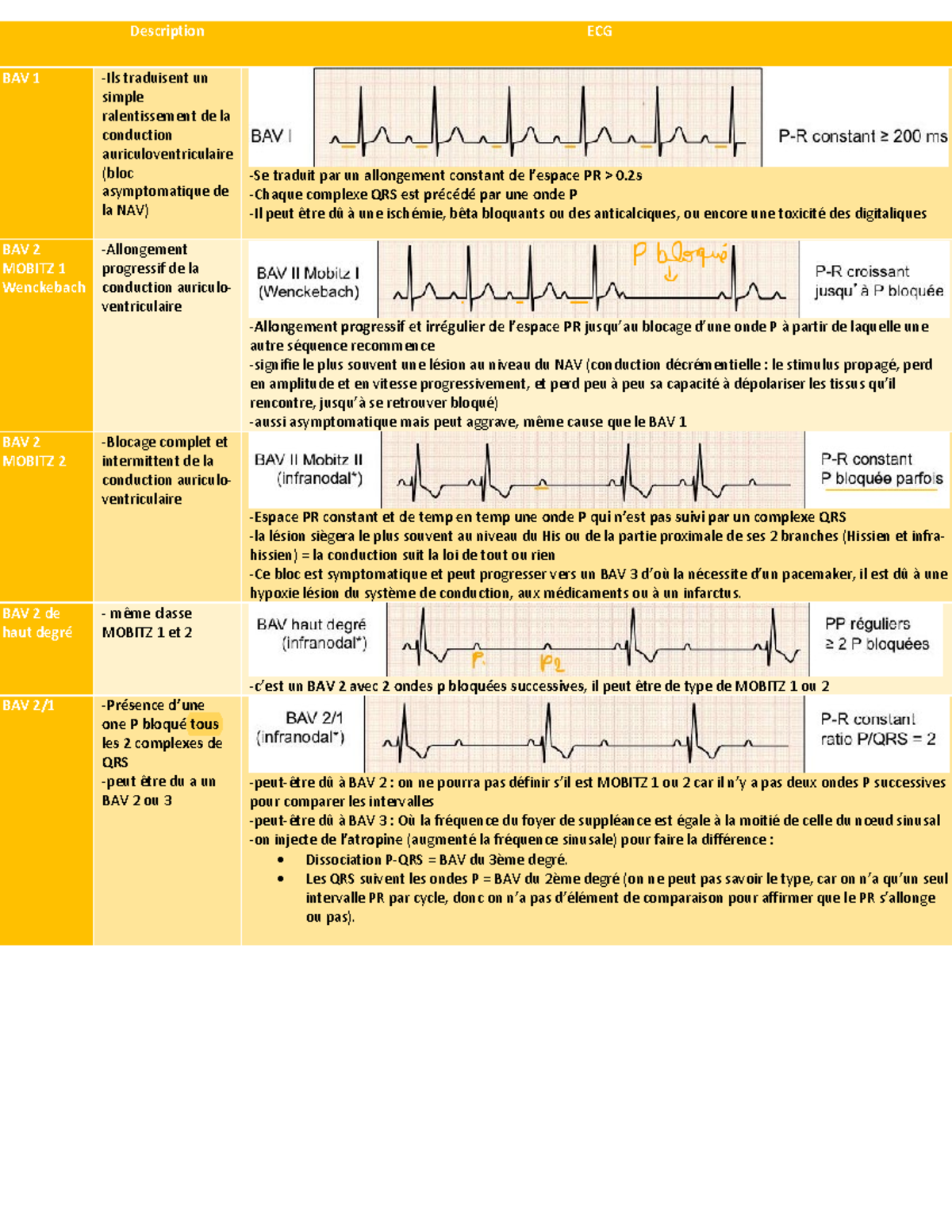 Mon résumé Trouble de la conduction - Description ECG BAV 1 - Ils ...